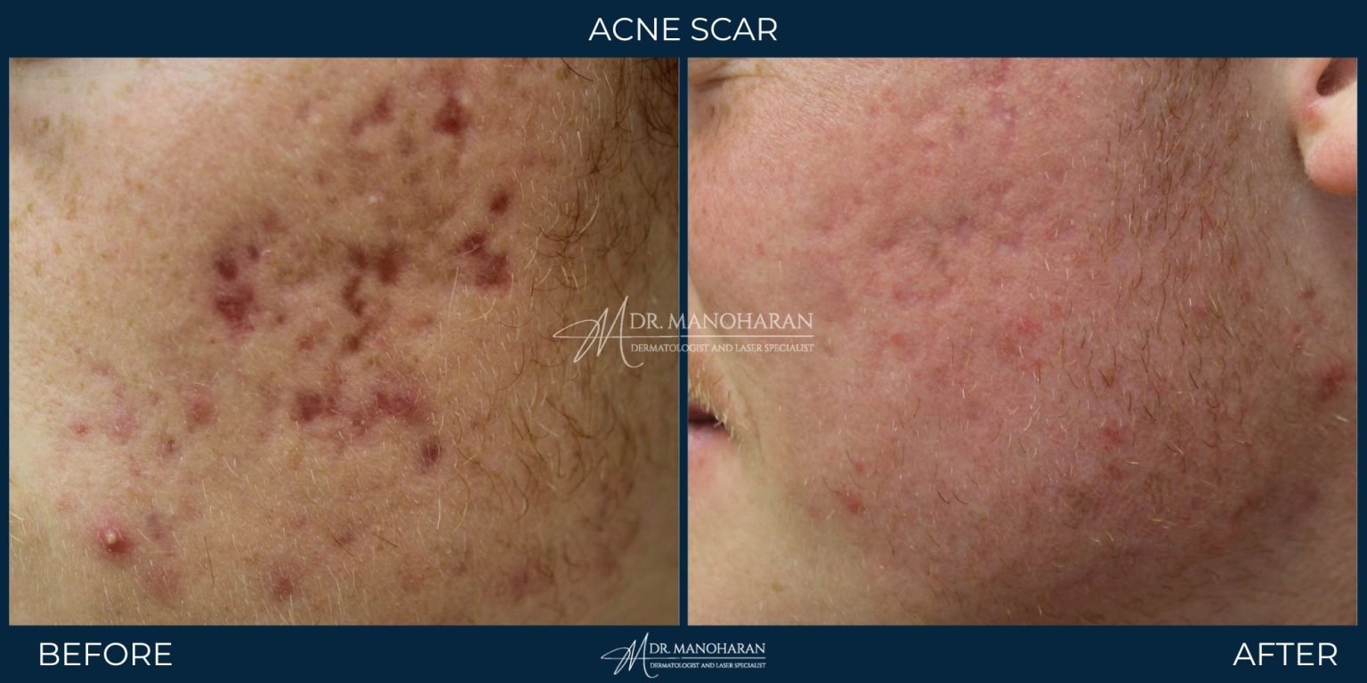 Acne Scar Laser Treatment before After: Stunning Results Revealed ...
