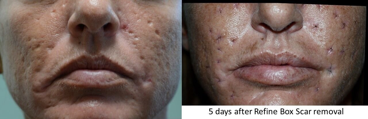 Ice Pick Acne Scars before And After: Stunning Transformations Revealed ...