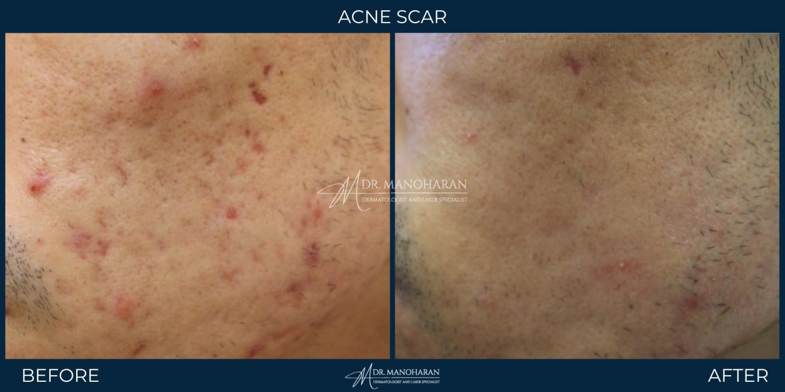Laser Treatment for Acne Scars before And After: Stunning Results ...